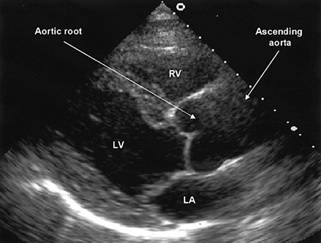 Familial Thoracic Aortic Aneurysm And Dissection (Familial TAAD) | VASCERN