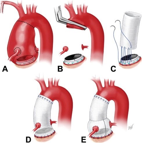 Familial Thoracic Aortic Aneurysm And Dissection (Familial TAAD) | VASCERN