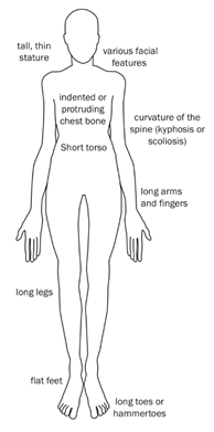 Marfan Syndrome | VASCERN