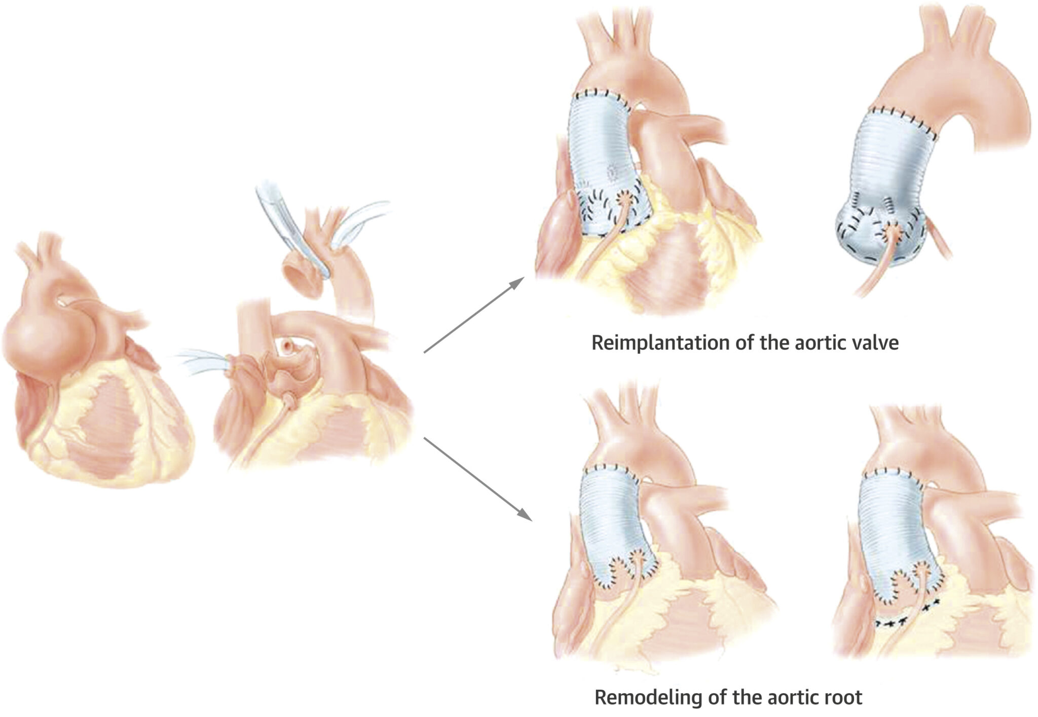 Familial Thoracic Aortic Aneurysm And Dissection (Familial TAAD) | VASCERN